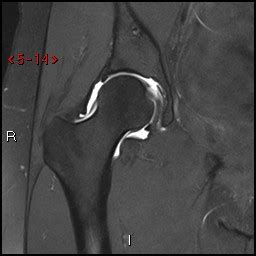 MRI Arthrogram Hip Rule Out Labral Tear Cedars Sinai