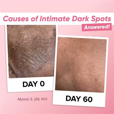 5 Causes Of Intimate Dark Spots Musely
