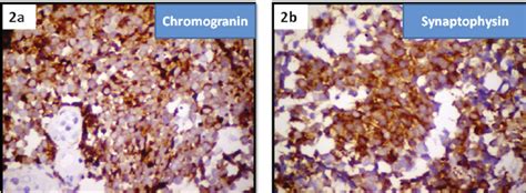Immuno Histochemistry Of Small Cell Neuroendocrine Carcinoma Cervix