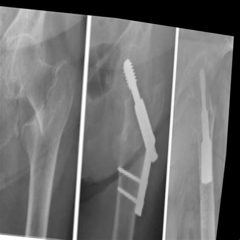 Hip Fracture Detection Object Detection Dataset V3 2023 02 14 8 31pm By Kmitl Medai