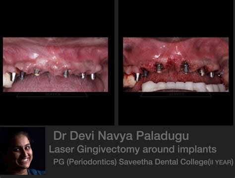 Gingivectomy Using Laser — Periodontics Saveetha