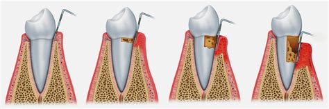 Perda Óssea Dentária Veja As Causas E Como Evitar Md Odontologia