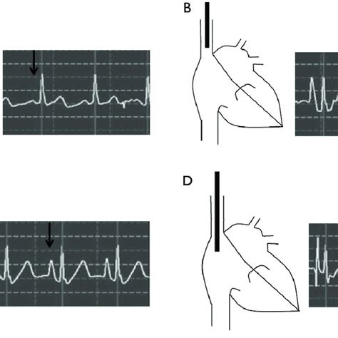 Predictable Modifications Of The Ecg Waveform On Lead Ii When The