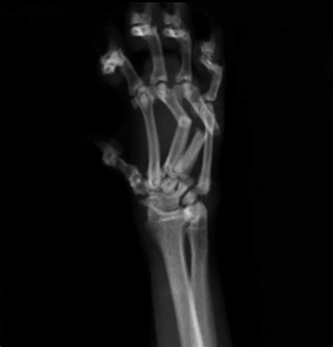 Artrovet Fractura De Metacarpianos