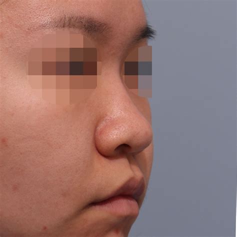Bulbous Tip Rhinoplasty Before And After Hanabi Rhinoplasty Clinic