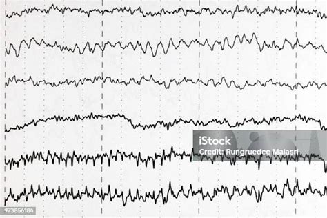 Brain Wave Patterns On Electroencephalogram Eeg Of The Pediatric Patients Problems In The