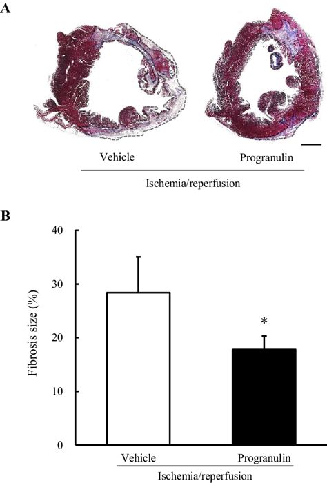 Administration Of Recombinant Progranulin Decreased Myocardial Fibrosis