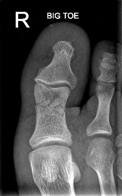 Fracture Toe Xray At Jackson Guilfoyle Blog