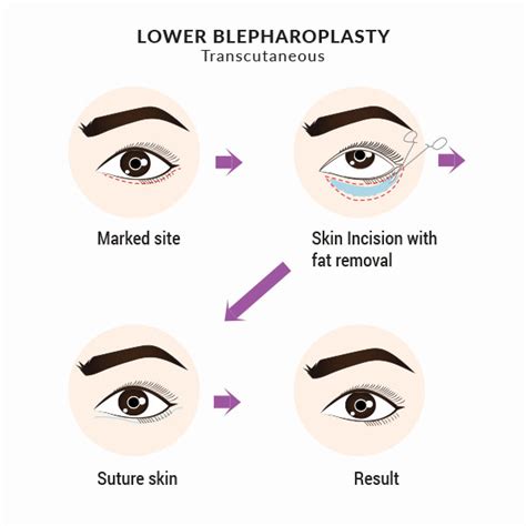 Blepharoplasty Divine Plastic Surgery