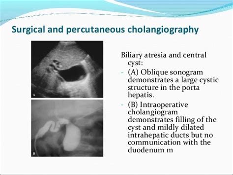 Biliary Atresia