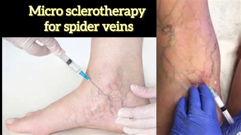 Micro Sclerotherapy For Spider Veins Youtube