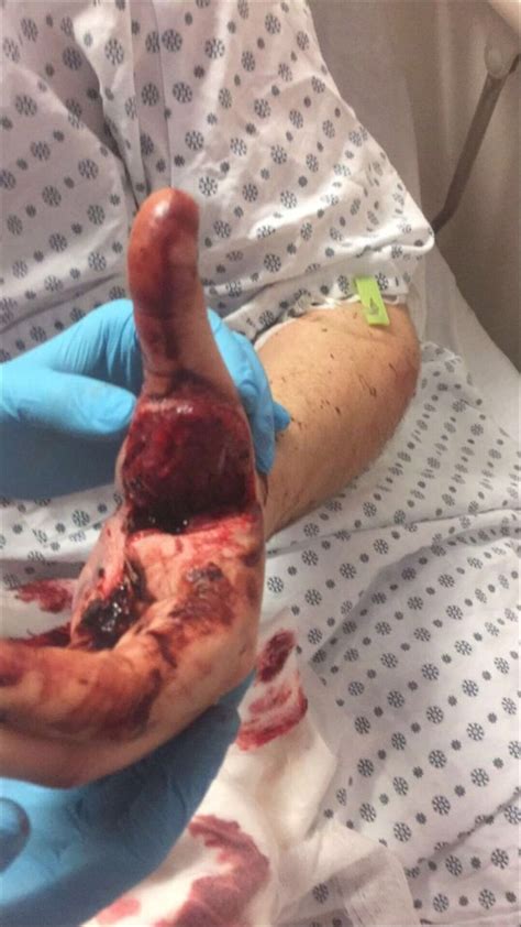 Saskatoon Man Left Bleeding Freezing After Struggle With Home Invaders