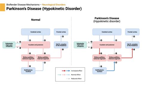 Parkinsons Disease Hypokinetic Disorder Biorender Science Templates