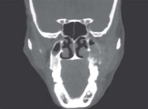 Coronal Ct Scan Showing A Space Occupying Lesion Seen Eroding The