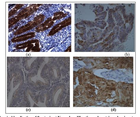 Figure 1 From Wntβ Catenin Signaling In Endometrioid Endometrial
