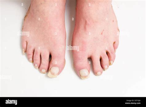 Mens Unkempt Feet With Long Uncut Nails The Concept Of Begging A Low