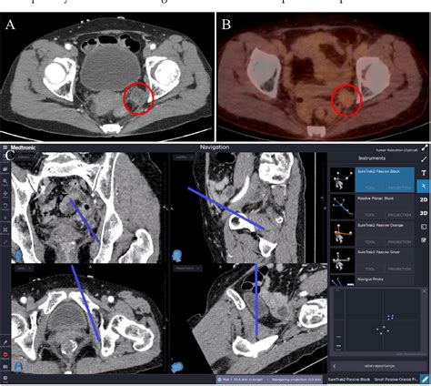 Figure 1 From Stereotactic Navigation Assisted Laparoscopic Resection