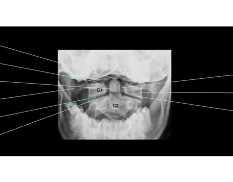 Open Mouth Odontoid View Quiz