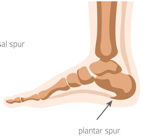 Tender Spot Bottom Of Foot 2026 Causes And Treatment Dpm