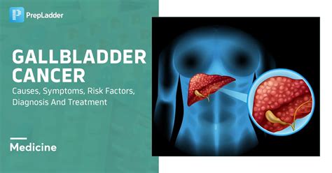 Gallbladder Cancer Causes Symptoms Risk Factors Diagnosis