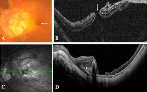 Macular Hole Formation After Intravitreal Conbercept Injection Three