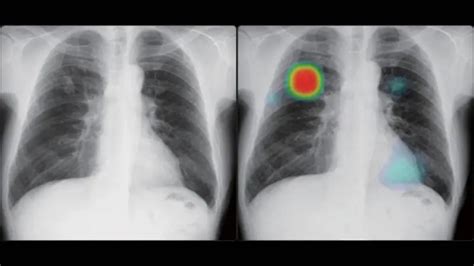 Insight Cxr Incepto Medical