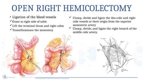Open Right Hemicolectomy General Surgery Course Pptx