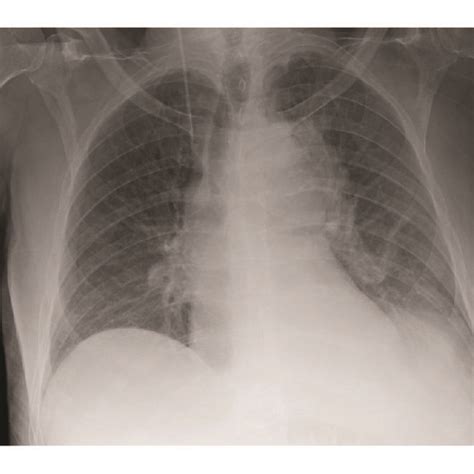 Ct Chest Sagittal View Showing Emphysematous Aortitis Download Scientific Diagram