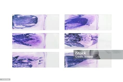 갑상선 미세 바늘 흡인 생검 후 유리 슬라이드 세트 조직학을위한 조직 생검 슬라이드 현미경 슬라이드에 대한 스톡 사진 및 기타