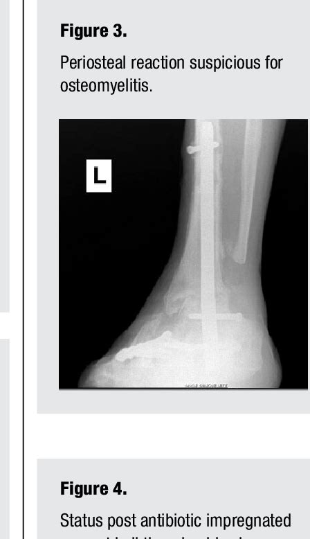 Figure 2 From Fibular Strut Graft For Revisional Tibiotalocalcaneal