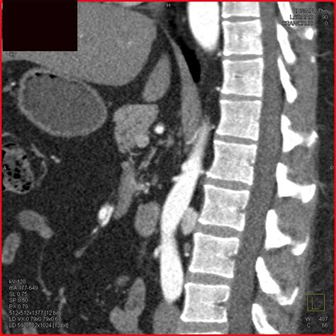 Right Aortic Arch And Celiac Dissection Vascular Radiology Case