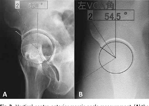 Figure 2 From Usefulness Of Measuring Acetabular Anterior Coverage