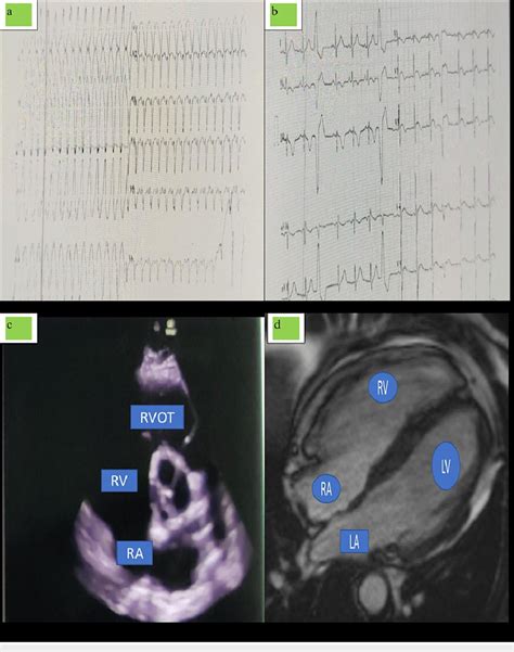 ECG 2D ECHO And MRI Findings Of Case 4 A ECG Showed Ventricular Download Scientific
