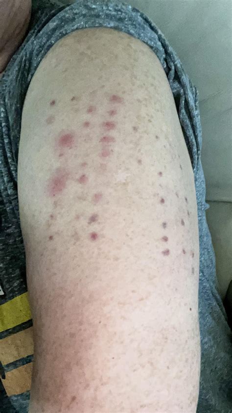 Allergy Testing R Allergy