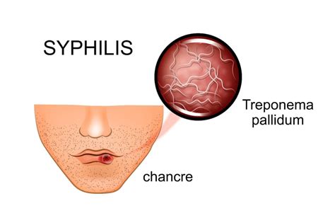 Secondary Syphilis The Great Imitator And Pretentious Rash Dr Ben