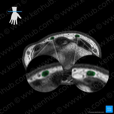 Os Hamatum Hakenbein Anatomie Entwicklung Und Klinik Kenhub