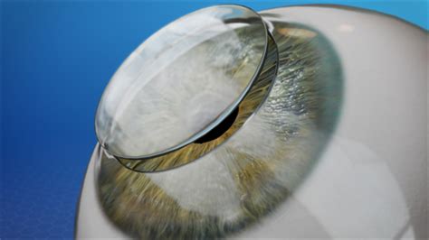 爱尔眼科做角膜移植手术怎么样爱尔眼科角膜移植技术实力强 角膜移植费用35000元起 耐看网