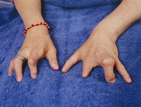 Ectodermal Dysplasia Stock Image M1500212 Science Photo Library
