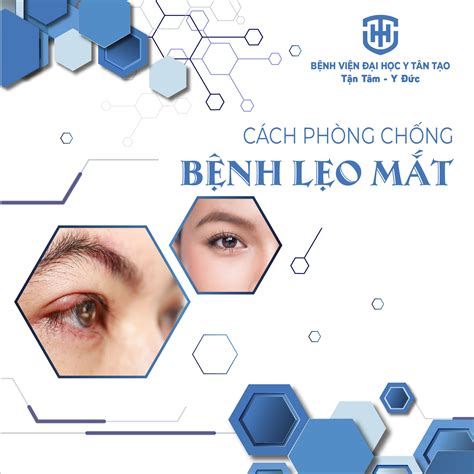 Cách Phòng Ngừa Bệnh Chắp Lẹo ở Mắt Bệnh Viện Đại Học Y Tân Tạo