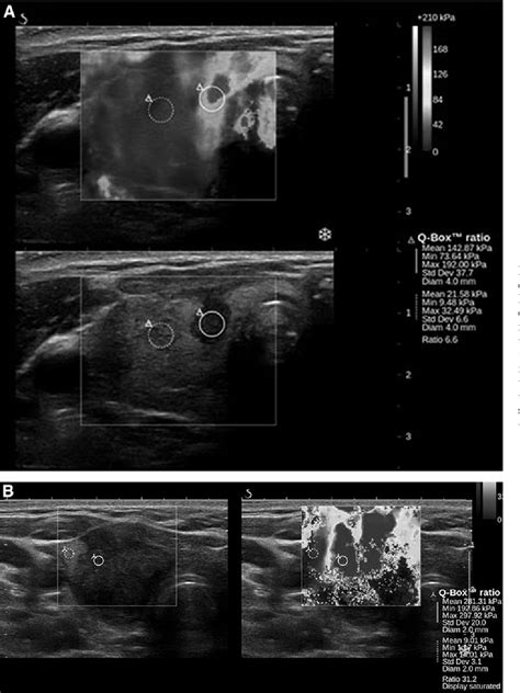 Figure 3 From Ultrasound Elastography And Fluorodeoxyglucose Positron