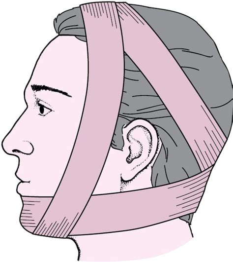 Mandibular Dislocation Dental Disorders Merck Manual Professional Edition