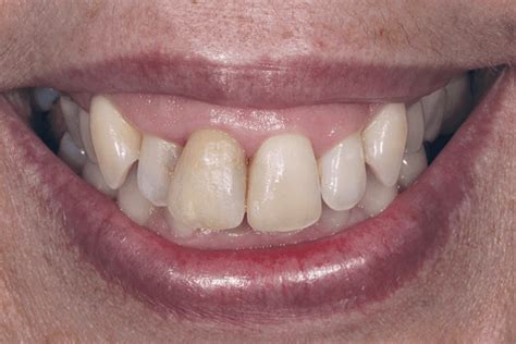 Reposicionamento Labial Cirúrgico Em Pacientes Com Aumento Vertical De