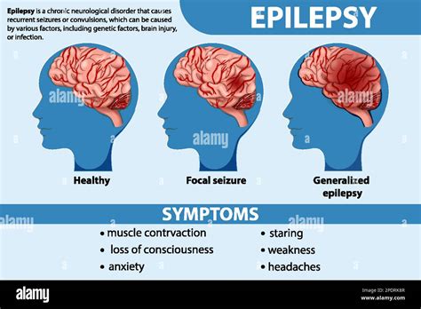 Informative Poster Of Epilepsy Illustration Stock Vector Image And Art