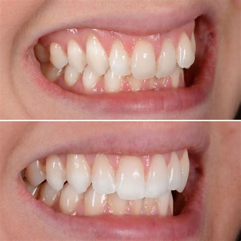 I Got Aligners On My Teeth These Are The Things I Wish Id Known