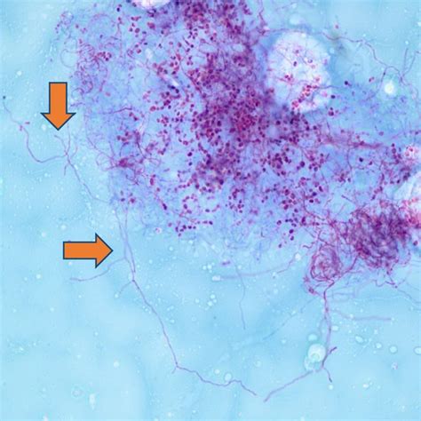 Gram Staining Of Right Middle Lobe Mass Revealed Branching