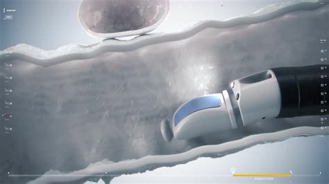 Dor Operation Endoventricular Circular Patch Plasty Department Of Cardiovascular Surgery Of