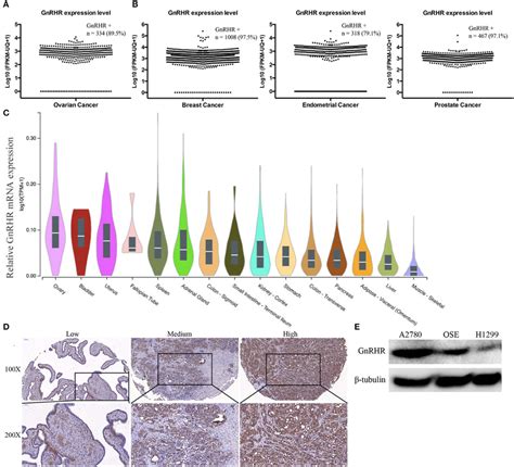Gonadotropin Releasing Hormone Receptor Is Overexpressed In Human