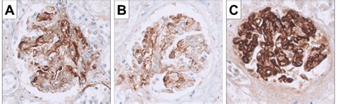 Staining For C4d A And B Cases Of Diffuse Mesangial Sclerosis Showing