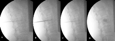 A Insertion Of The Guidewire B Obtaining Biopsy Samples From The