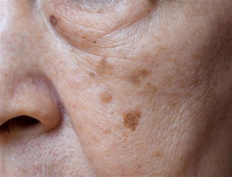Lentigines — Fora Dermatology General And Surgical Dermatology In Mooresville Nc